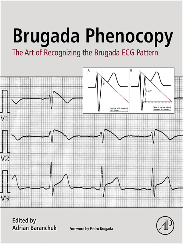 Brugada Phenocopy: The Art of Recognizing the Brugada ECG Pattern ...