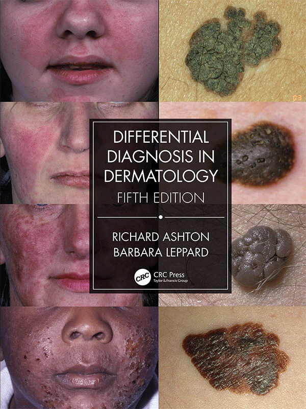Differential Diagnosis in Dermatology, 5th Edition | Vasiliadis Medical Books